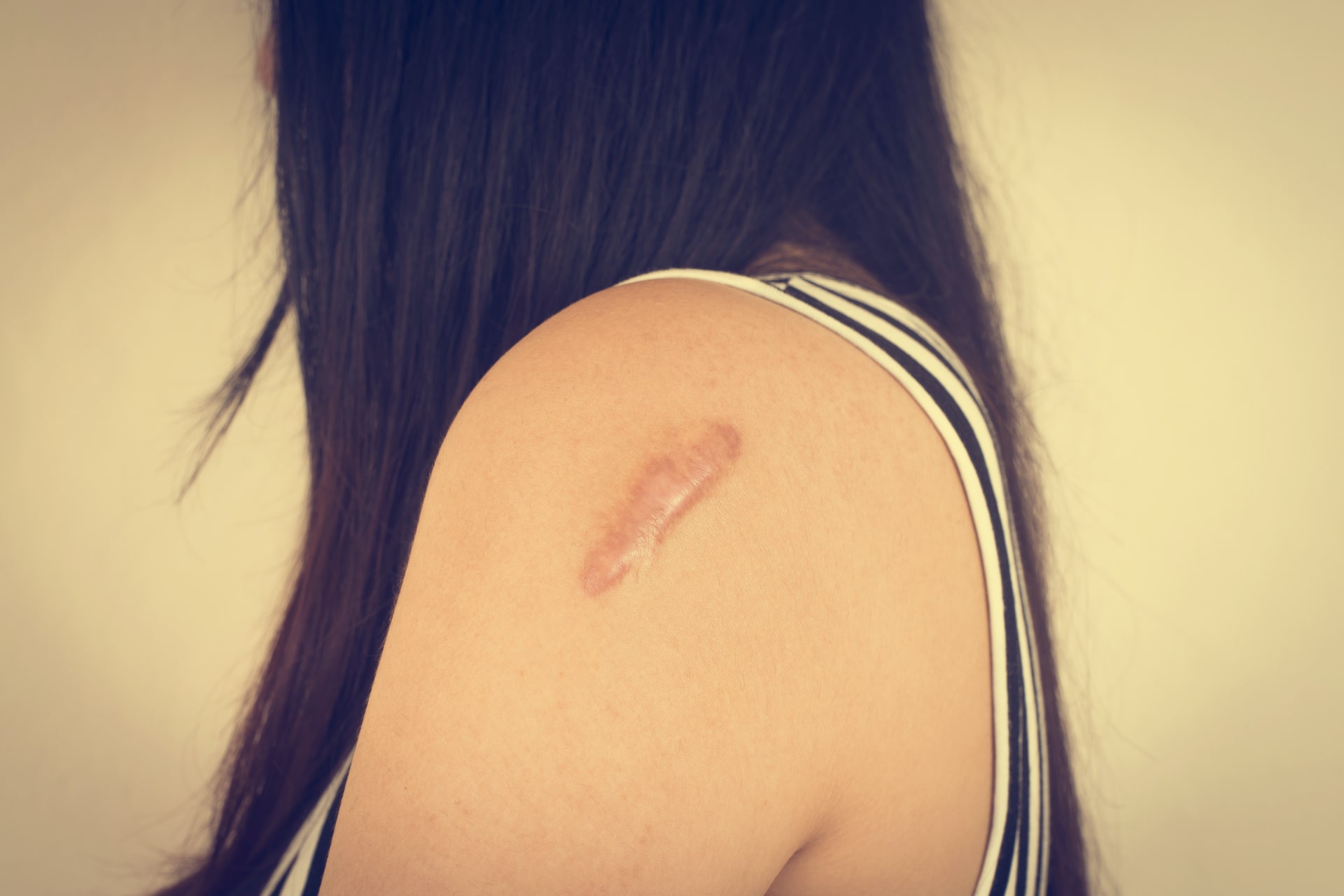 Scar Removal - Derma Revive Surgery